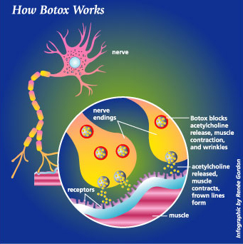 Prinzip der Wirkung - Botulinumtoxin - Estetické centrum Praha - Botox